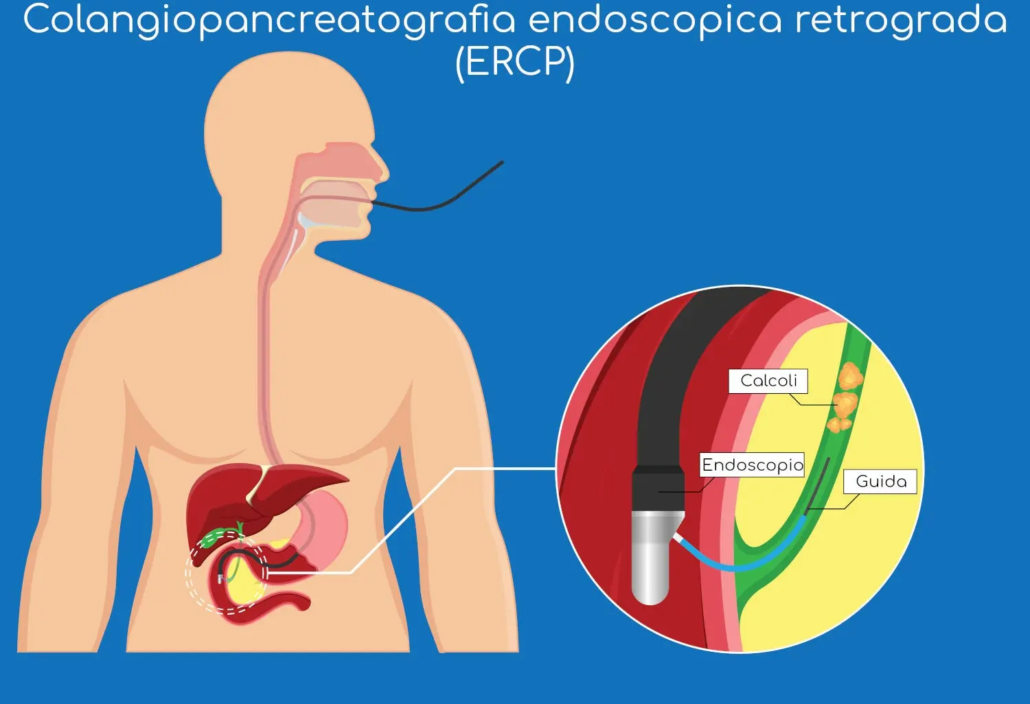 Ercp: Procedimiento Para Diagnóstico Y Tratamiento | Botoxina